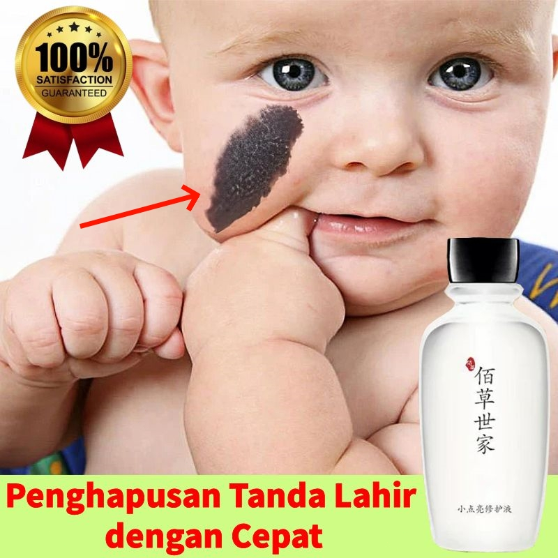 Jual Obat Penghilang Tanda Lahir Penghilang tanda lahir coklat Hapus ...