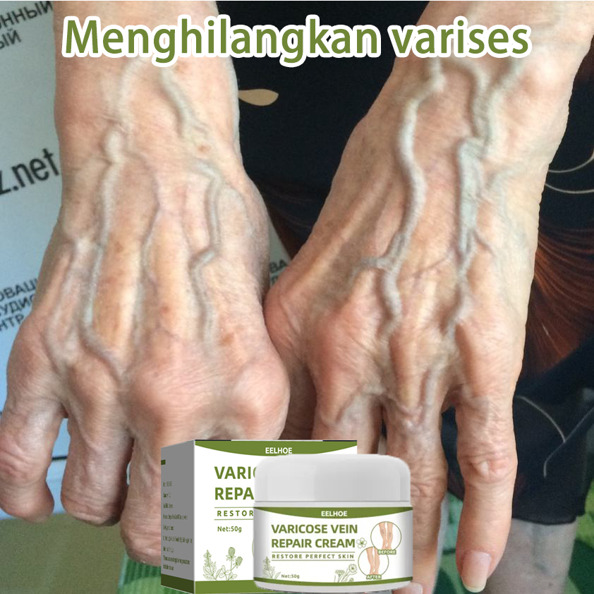 Jual Obat Varises Paling Ampuh Menghilangkan varises Varicose Veins ...