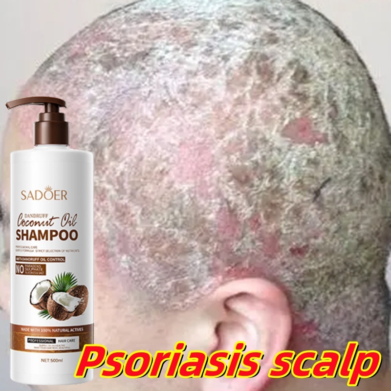 Jual Shampo Anti Ketombe Shampo Kelapa Pelembab Shampo Anti Ketombe Dan Rontok Sampo Pelembab ...