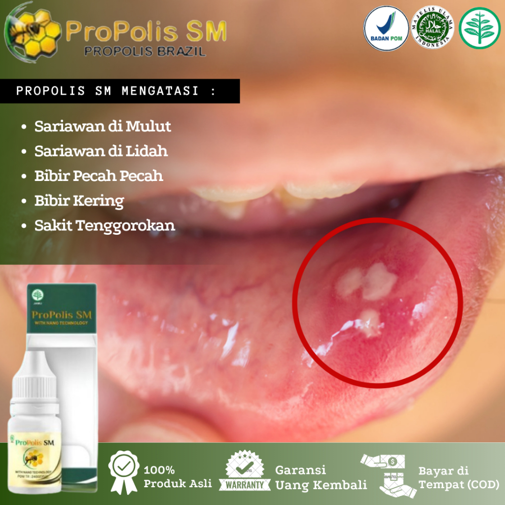 Jual Obat Sariawan di Mulut, Sariawan di Bibir, Sariawan di Lidah, Luka ...