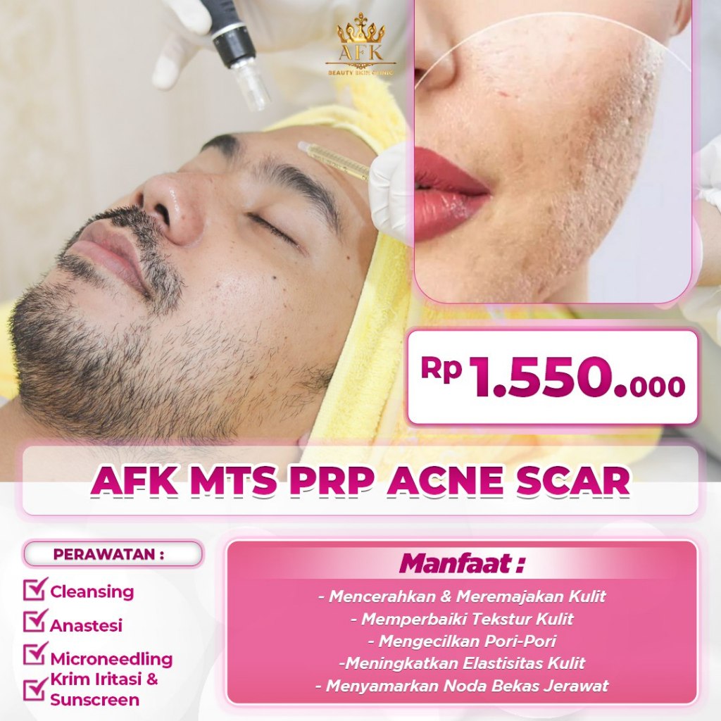 Jual AFK MTS PRP ACNE SCAR | Shopee Indonesia