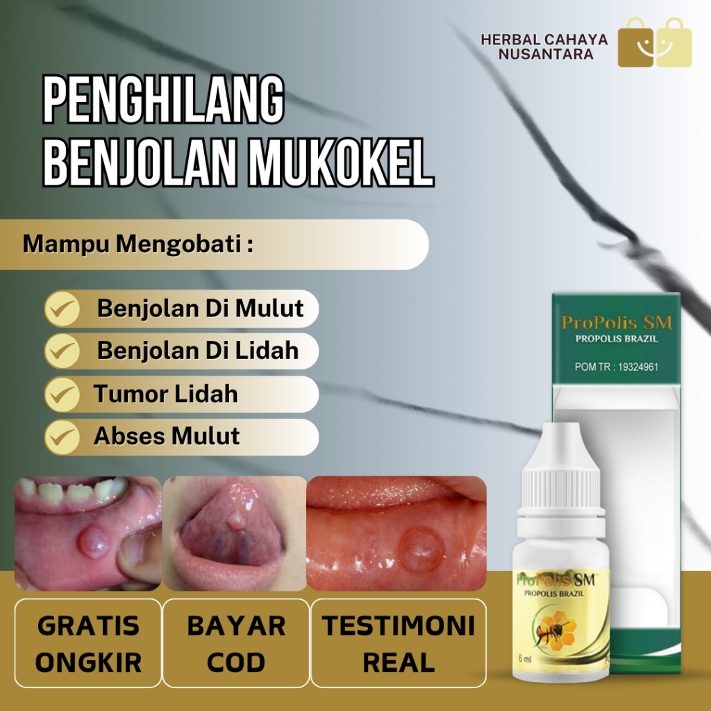 Jual Obat Mukokel Penghilang Benjolan Di Bawah Lidah, Obat Benjolan Di Mulut, Obat Benjolan Di ...