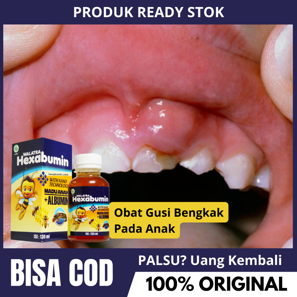 Jual Obat Gusi Bengkak Anak, Radang Gusi Anak, Nyeri Gusi Anak, Obat ...