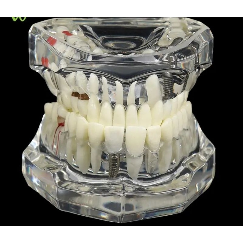 Jual Dental model study gigi edukasi transparan study implant phantom ...