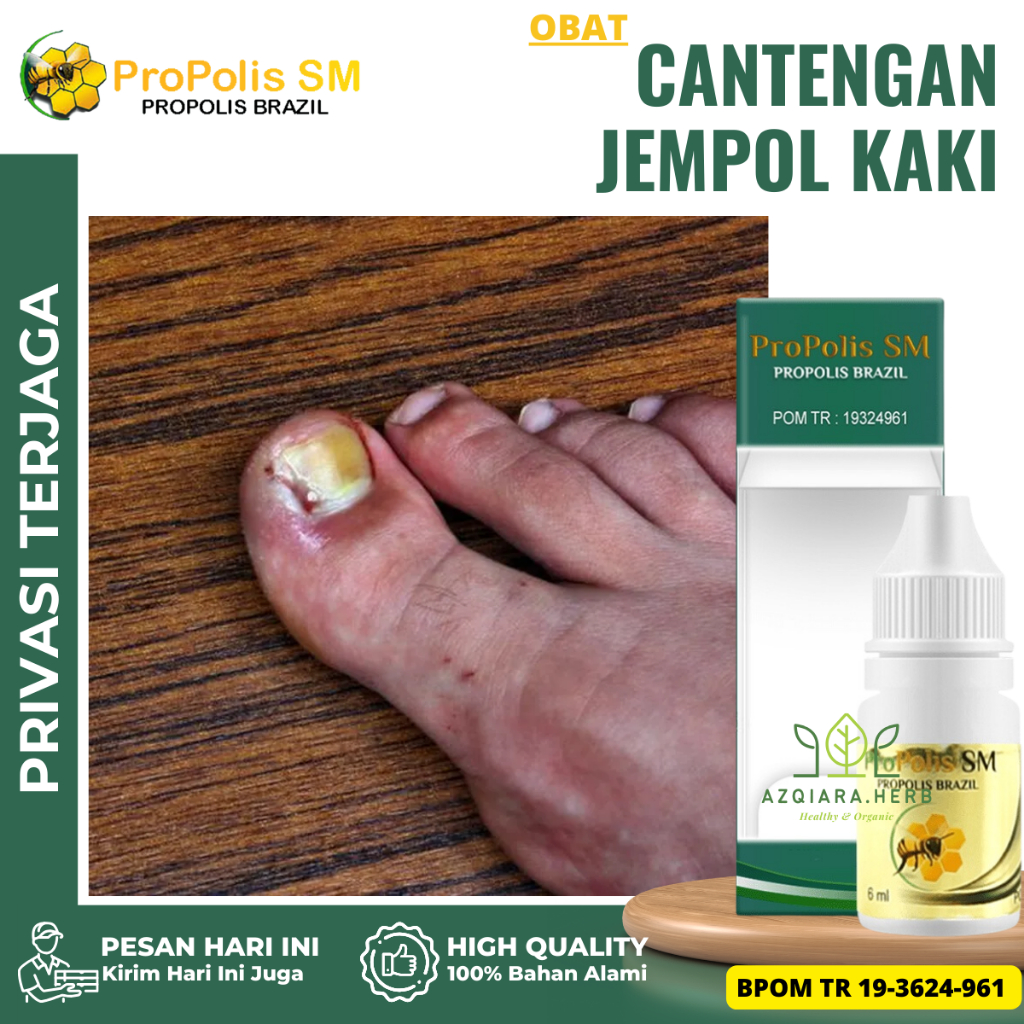 Jual Obat Cantengan Jempol Kaki, Obat Jamur Kuku Kaki, Obat Cantengan ... Jual Obat Cantengan Jempol Kaki, Obat Jamur Kuku Kaki, Obat Cantengan ...