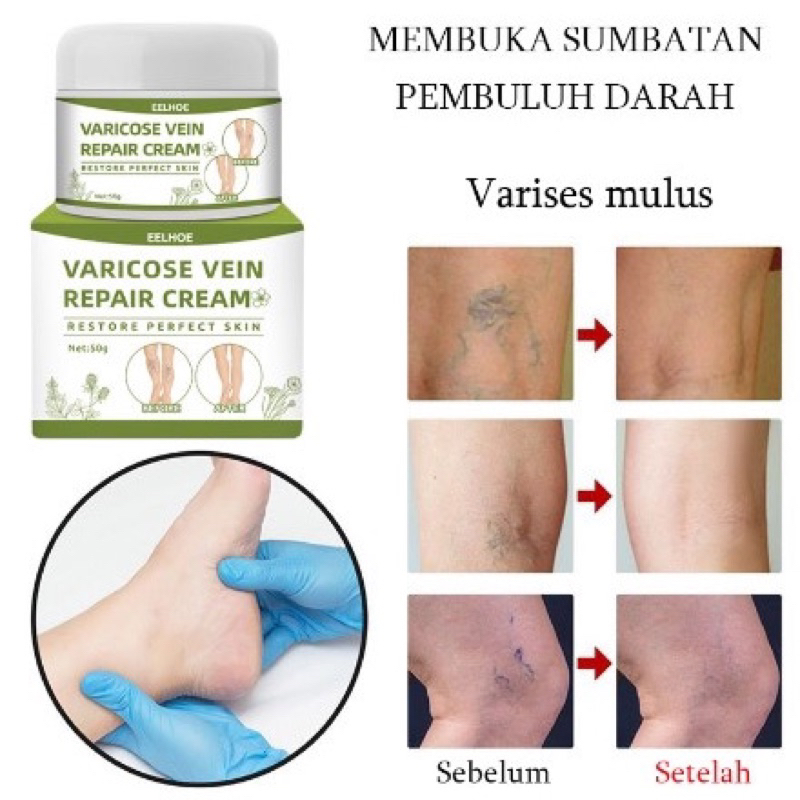 Jual EELHOE Varicose Veins Obat Varises Varikokel Bengkak Benjolan ...