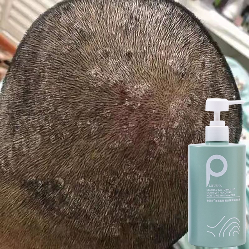 Jual Obat ketombe Sampo Garam Laut shampoo anti ketombe sampo psoriasis ...