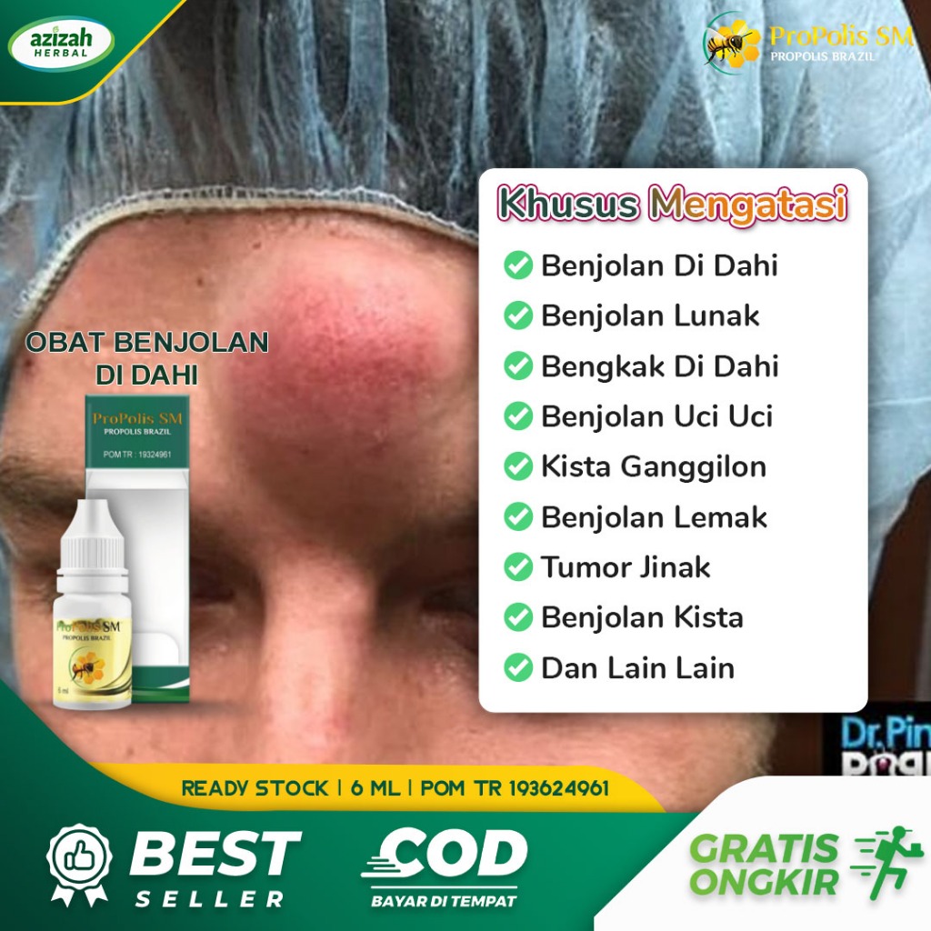 Jual Obat Benjolan Di Dahi Sebelah Kiri Kanan Benjolan Lunak Lipoma Uci ...
