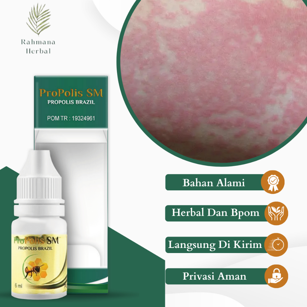 Jual Obat Tetes Ruam Kulit, Obat Gatal Ruam Kulit, Obat Tinea Corporis ...