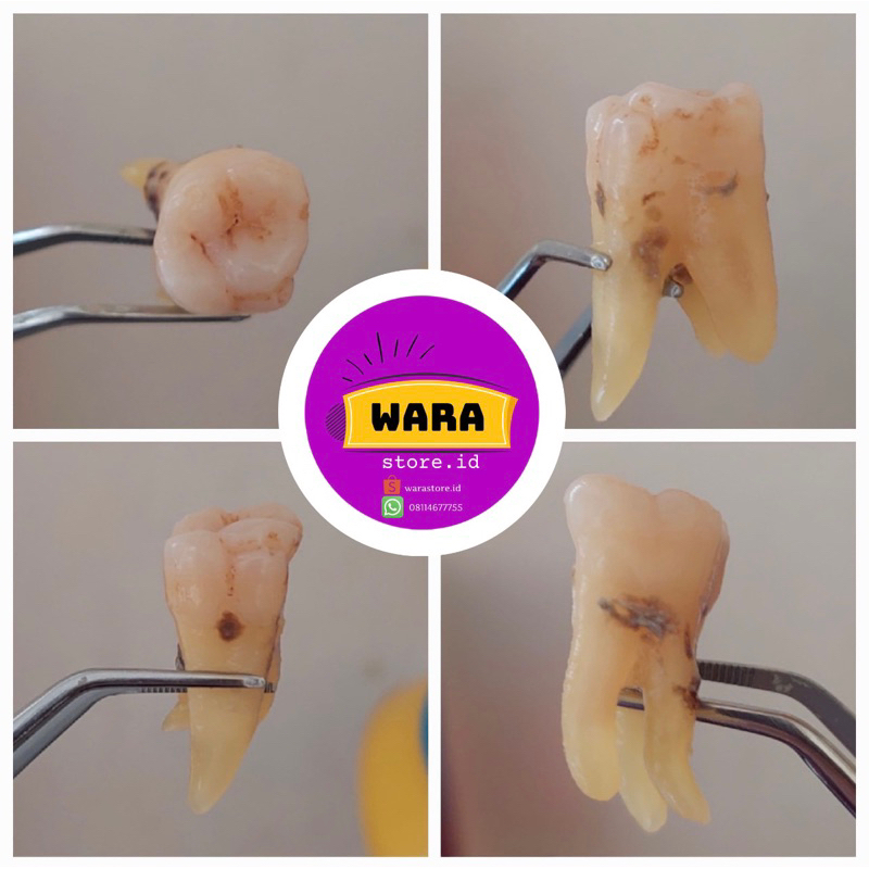 Jual Gigi molar 1 2 3 dewasa rahang atas kanan dan kiri (unsur 16 17 18 ...