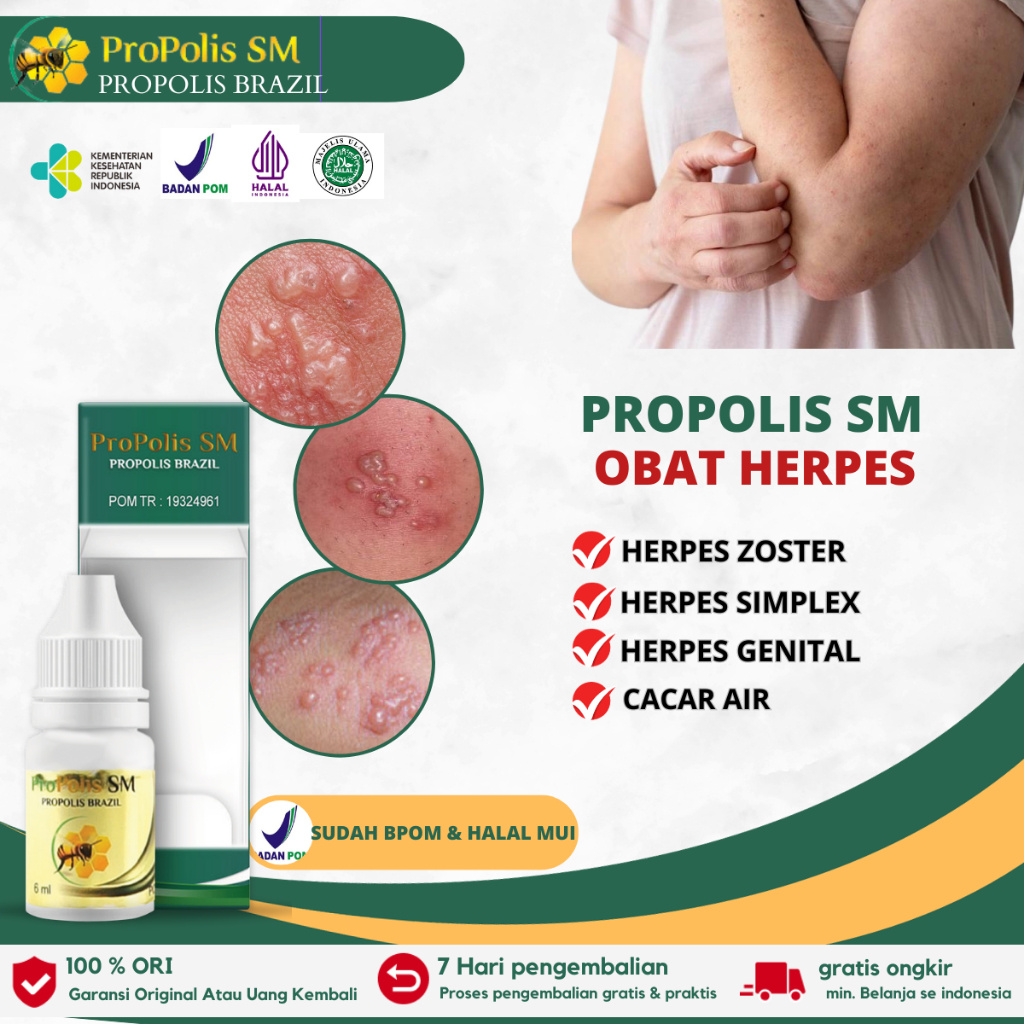 Jual Obat Herpes, Obat Penghilang Herpes Gatal Berair, Salep Herpes ...