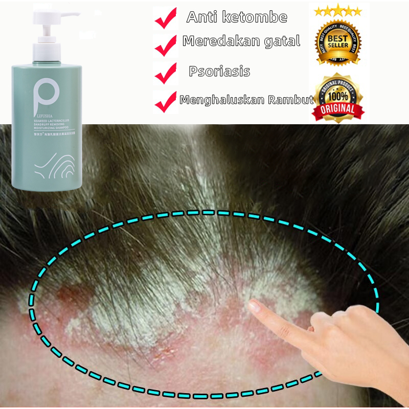 Jual Obat ketombe Sampo Garam Laut shampoo anti ketombe sampo psoriasis ...