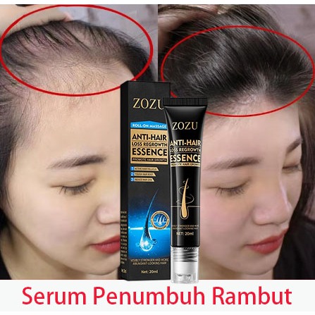 Jual Serum penumbuh rambut penumbuh rambut botak obat penumbuh rambut ...