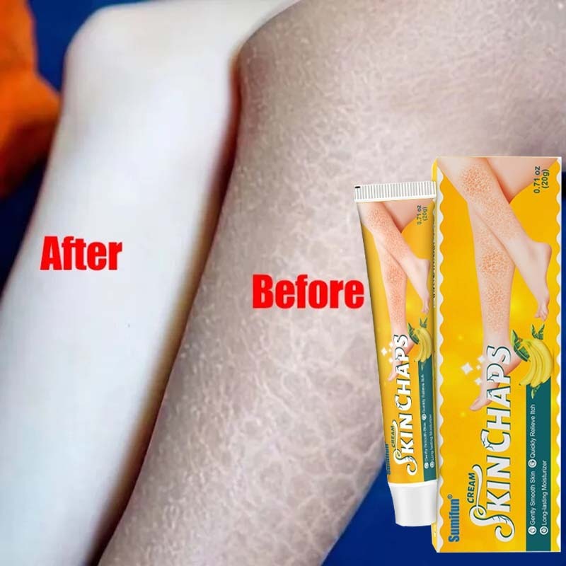 Jual Obat gatal kulit Salep eksim Iktiosis Iktiosis kulit Obat jamur ...