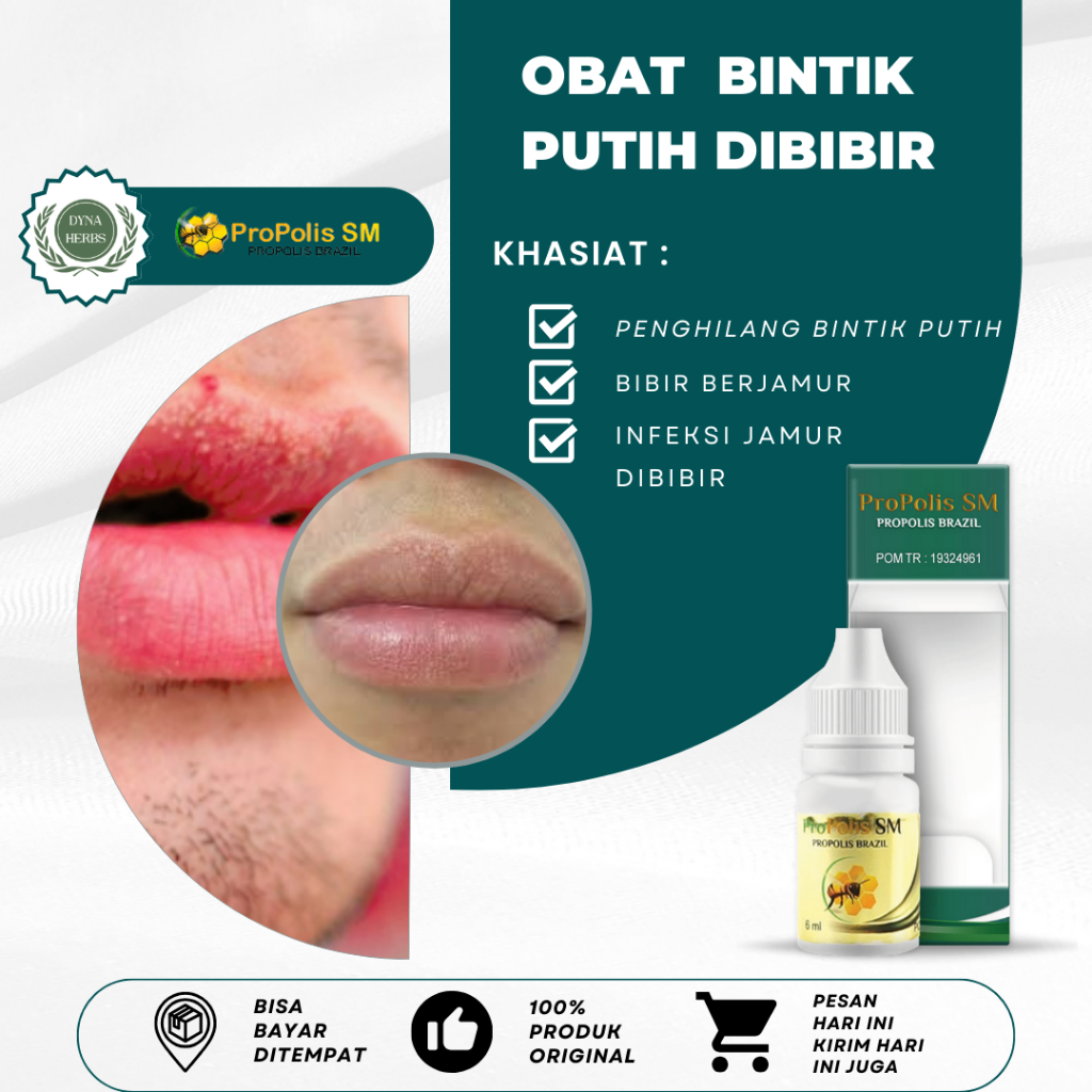 Jual Obat Oles Penghilang Bintik Putih di Bibir, Obat Fordyce Spot ...