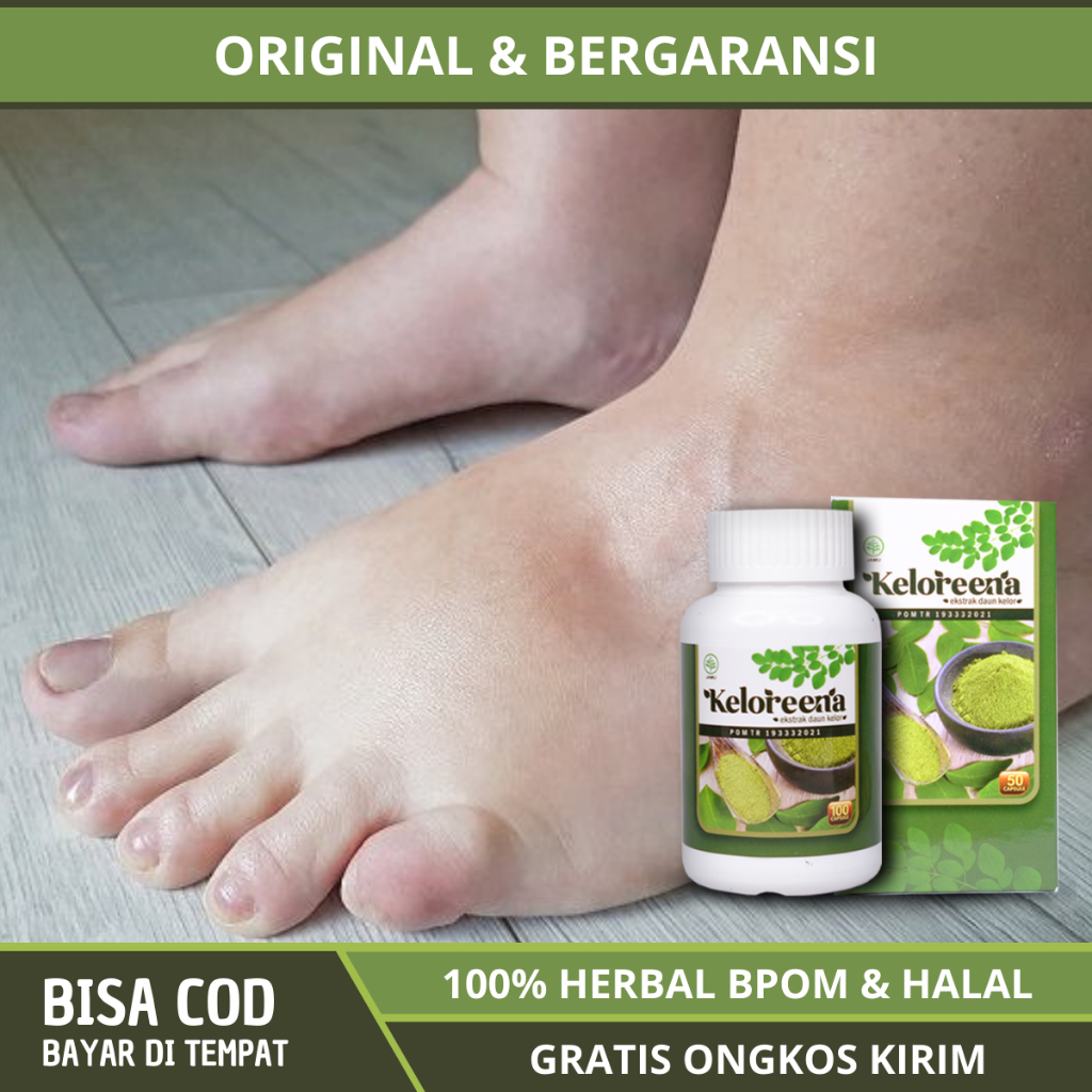 Jual Obat Kaki Bengkak Diabetes Asam Urat Jantung dan Ginjal, Obat Kaki ...