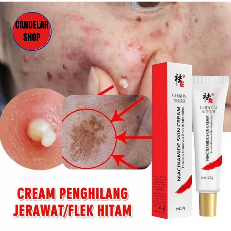 Jual [BPOM] COD GRATIS ONGKIR Cindynal Obat Cream Penghilang Jerawat Bintik Hitam Flek Hitam ...