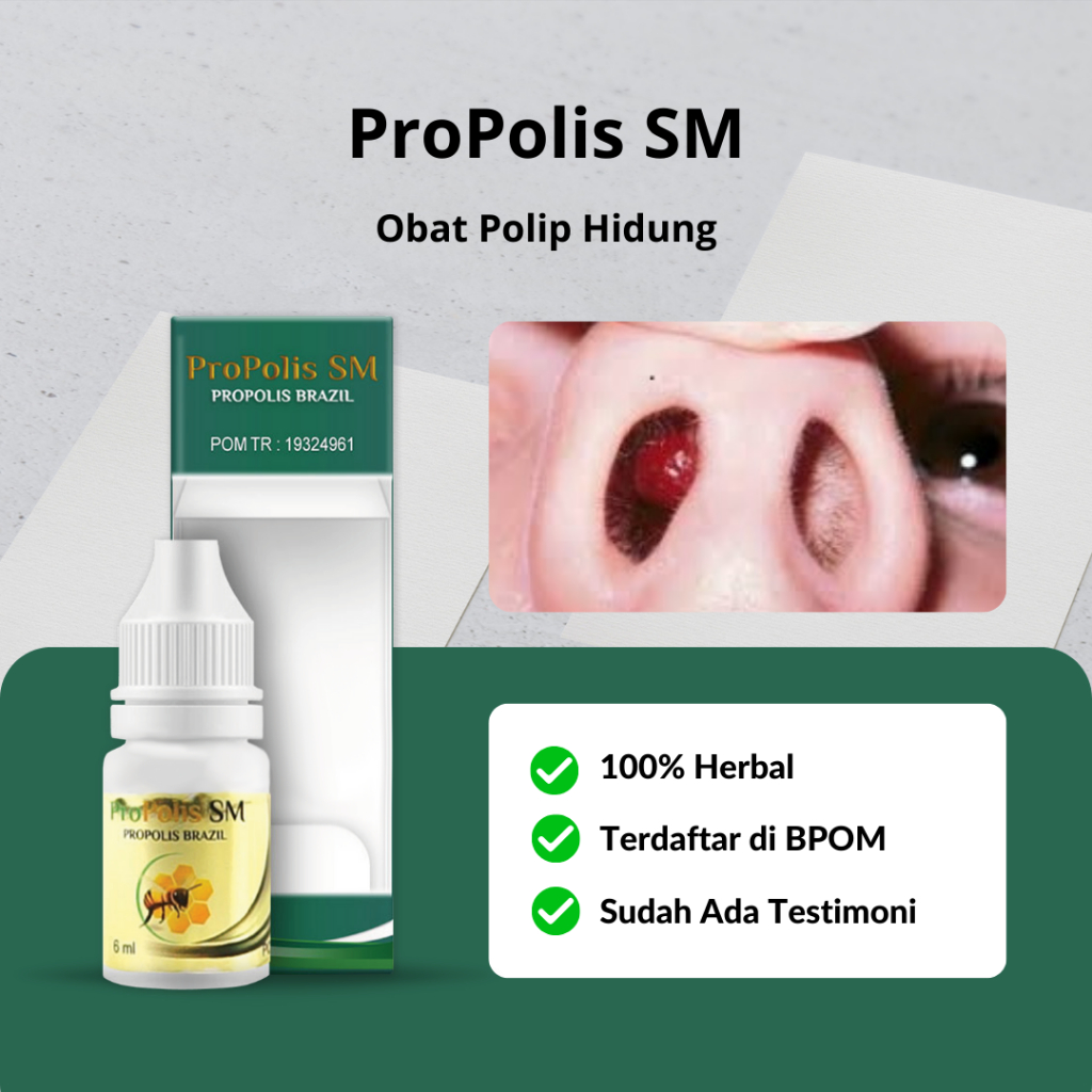 Jual Propolis SM - Obat Polip Hidung, Obat Benjolan di Dalam Hidung ...