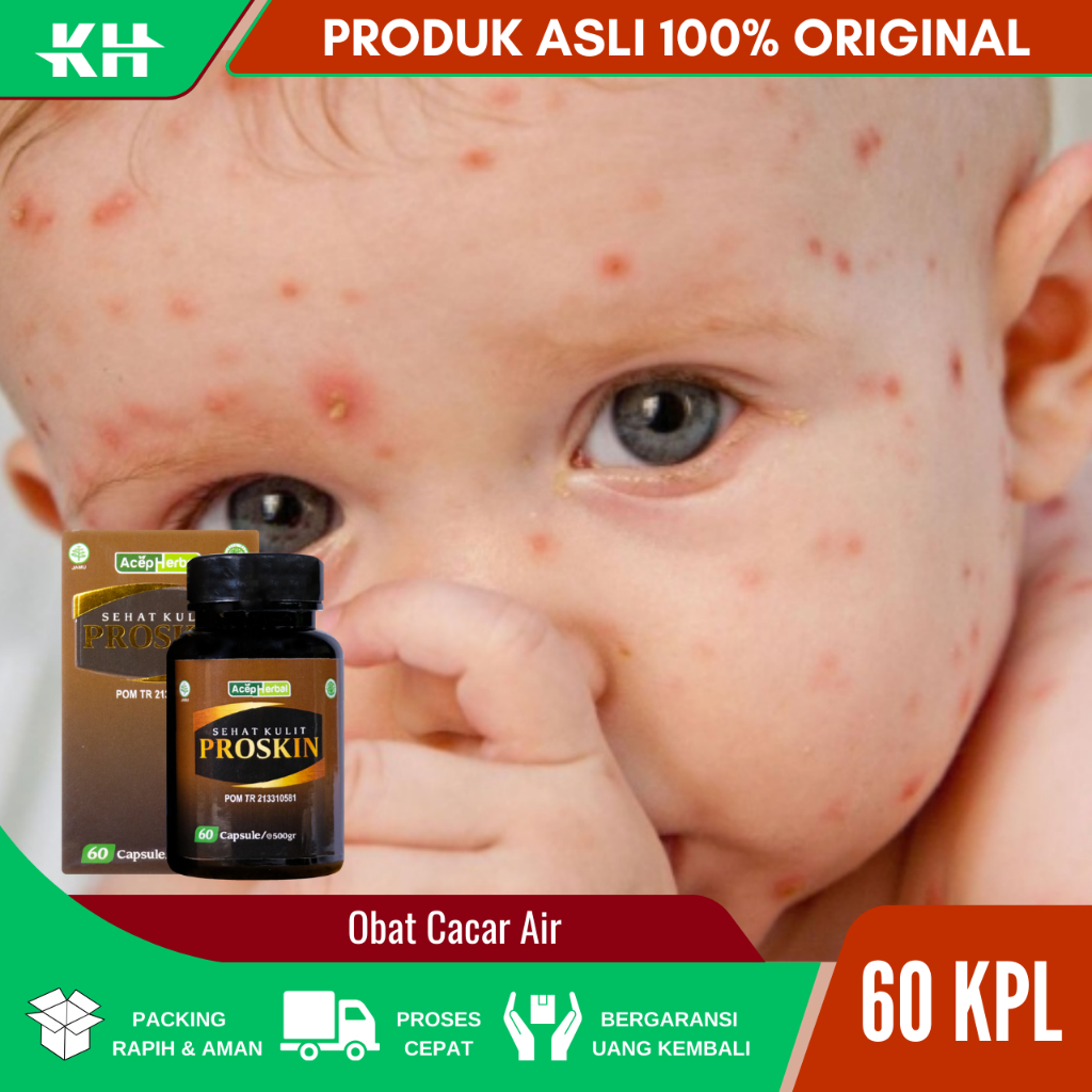 Jual Obat Cacar Air Anak, Obat Cacar Air Dewasa, Obat Cacari Air bayi ...