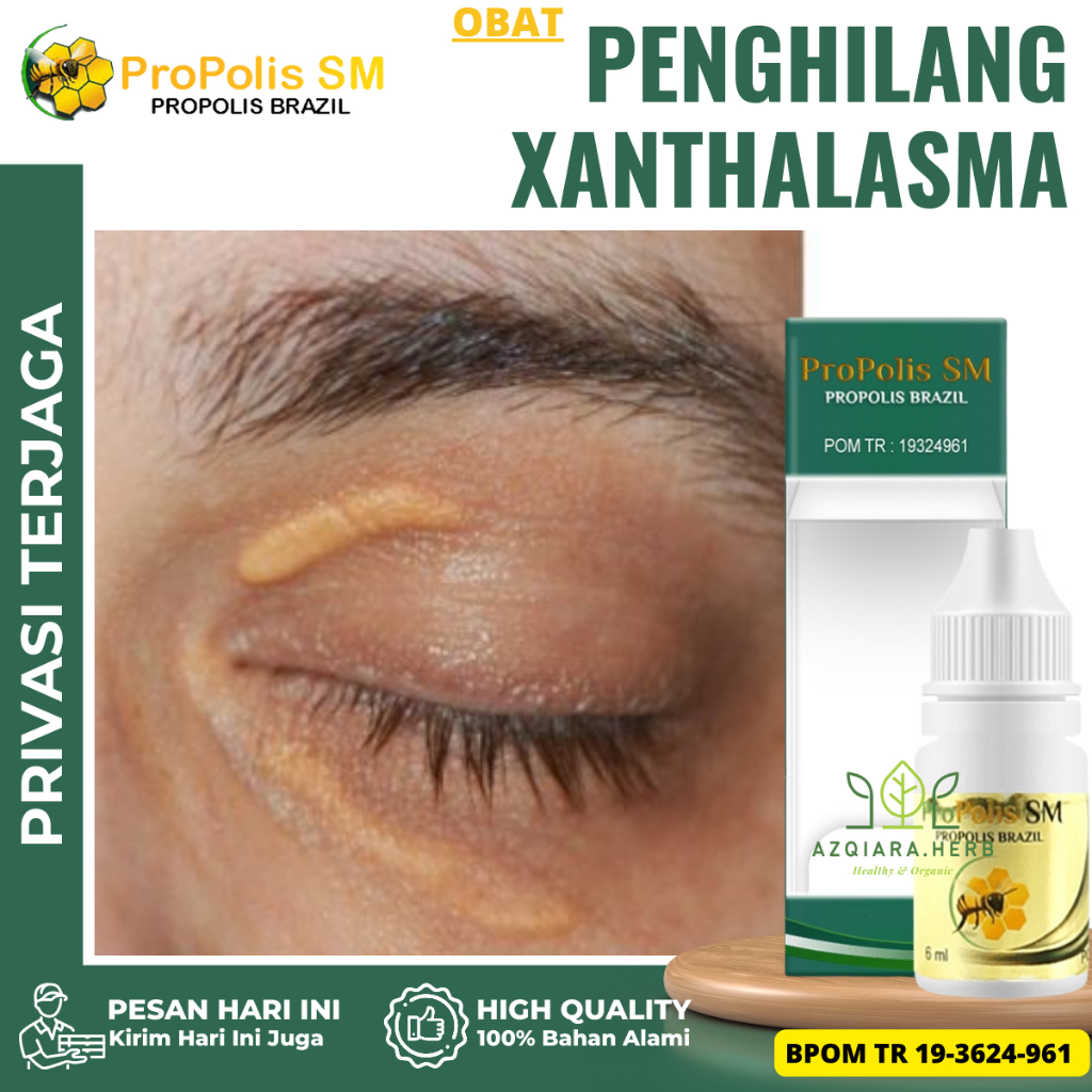 Jual Obat Xanthelasma, Obat Penghilang Gumpalan Lemak di Kelopak Mata ...