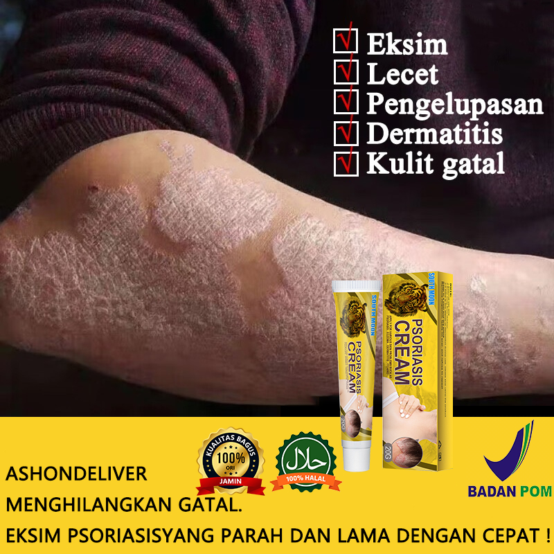 Jual Salep Gatal Paling Ampuh Salep Jamur Kulit gatal Salep Eksim Salep ...