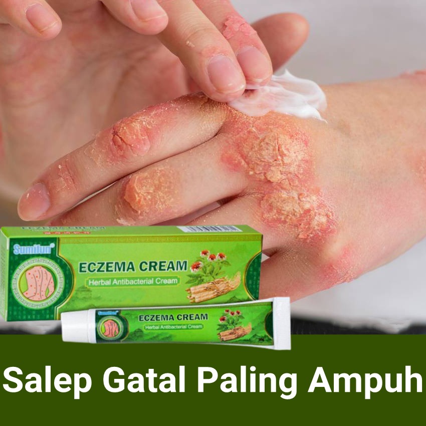Jual Salep Gatal Paling Ampuh Krim Herbal Untuk Eksim Psoriasis Kadas ...