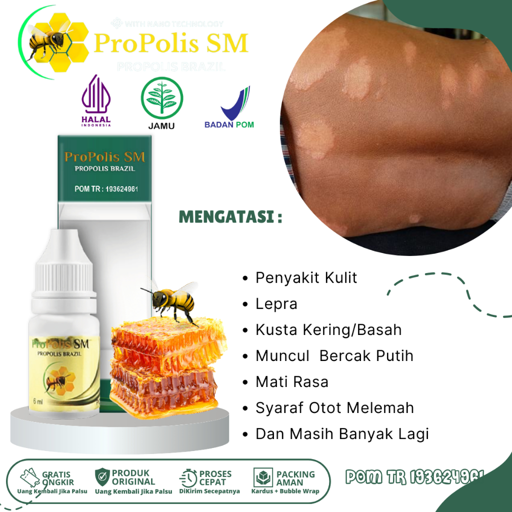Jual Obat Lepra Kusta Kering/Basah Muncul Bercak Putih luka Kulit ...