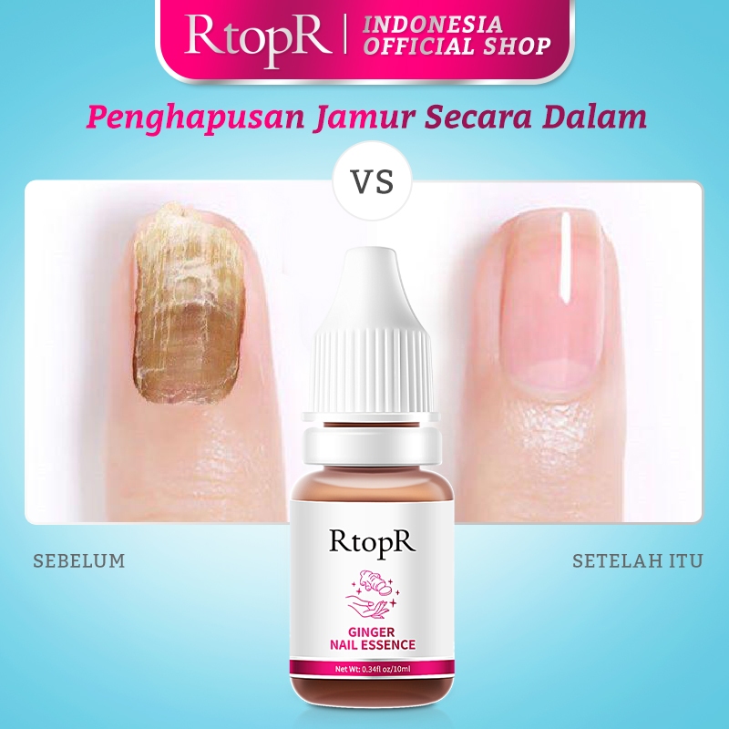 Jual 【BPOM】RtopR Jahe Antibakteri Perawatan Kuku Onikomikosis ...