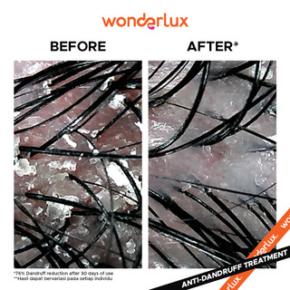 Jual Wonderlux Break Me Free! Anti Dandruff Shampoo For Sensitive Scalp ...