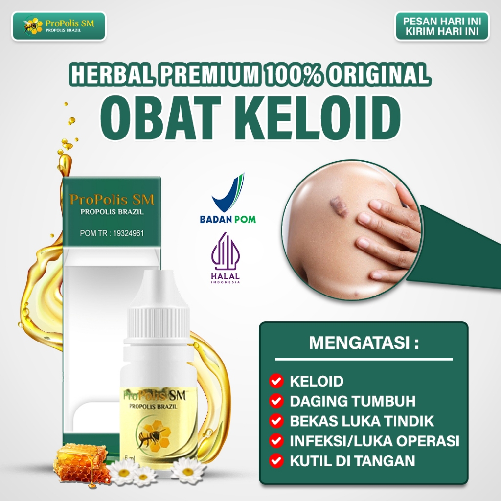 Jual Obat Keloid - Daging Tumbuh - Daging Jadi - Penghilang Keloid Bekas Operasi Propolis SM ...