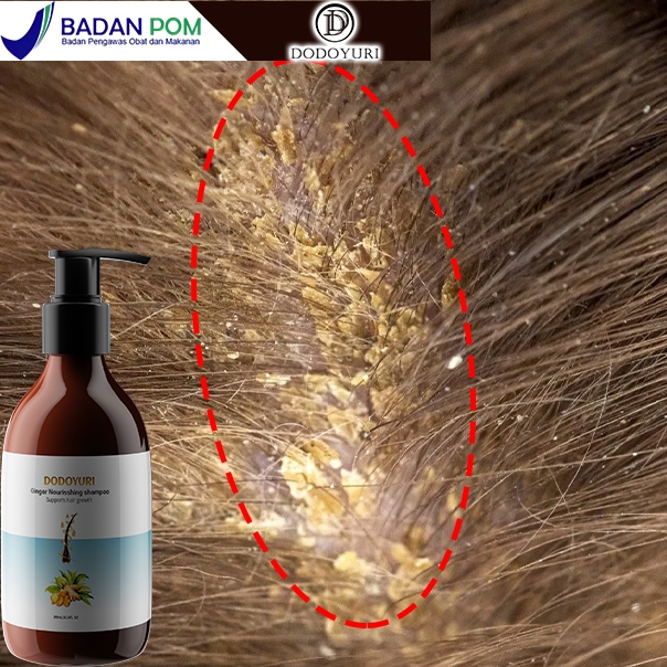 Jual 【BPOM】Sampo ketombe sampo anti ketombe shampo anti ketombe 300ml sampo anti ketombe dan ...