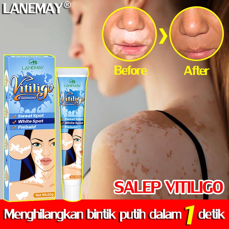 Jual [100% Asli ] Salep vitiligo, panu, biang keringat, salep panu anti ...