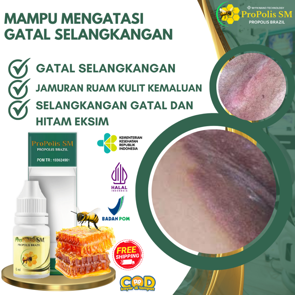 Jual Obat Gatal Selangkangan, pemutih selangkangan Hitam, Kurap Di ...