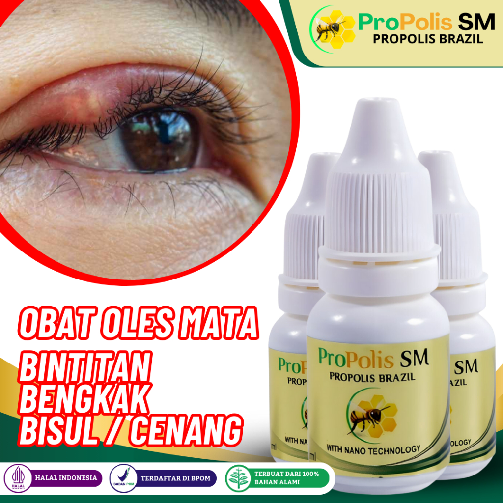 Jual Obat Oles Untuk Mata Bengkak, Mata Bintitan, Mata Kalazion, Mata ...