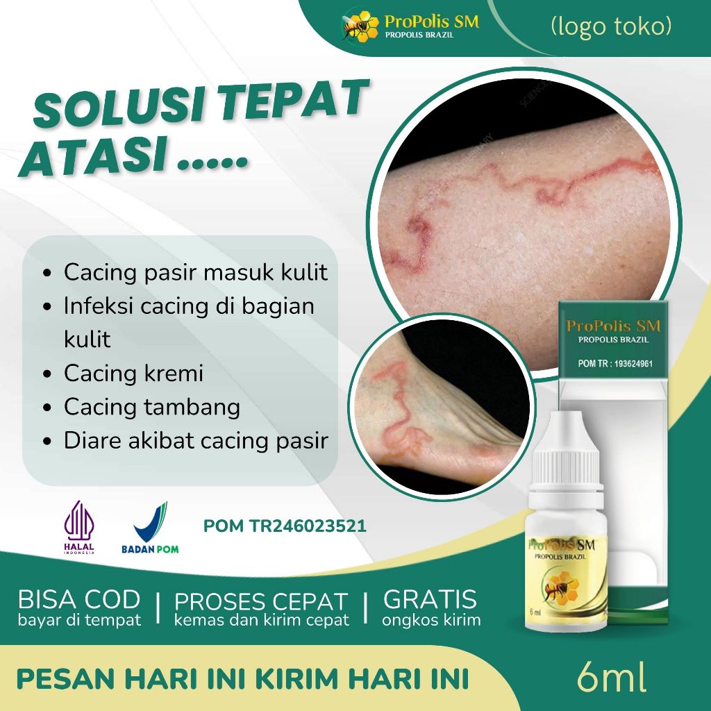 Jual Obat Penghilang Cacing Pasir Kulit, Obat Cutaneous Larva Migrans ...