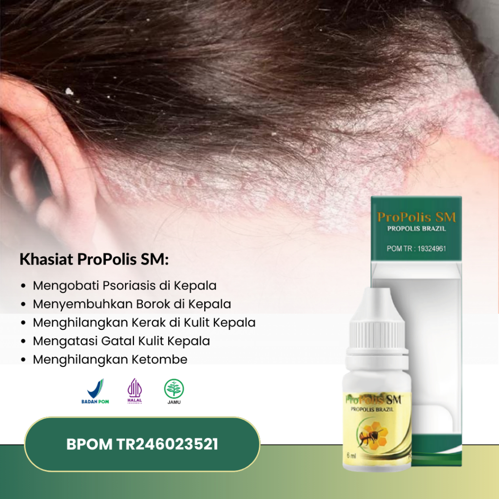 Jual Obat Psoriasis Kulit Kepala, Obat Ketombe Kerak Kulit Kepala, Obat Gatal Kulit Kepala ...