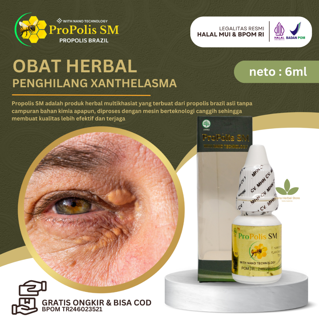 Jual Obat Penghilang Gumpalan Lemak Di Kelopak Mata Xanthelasma ...