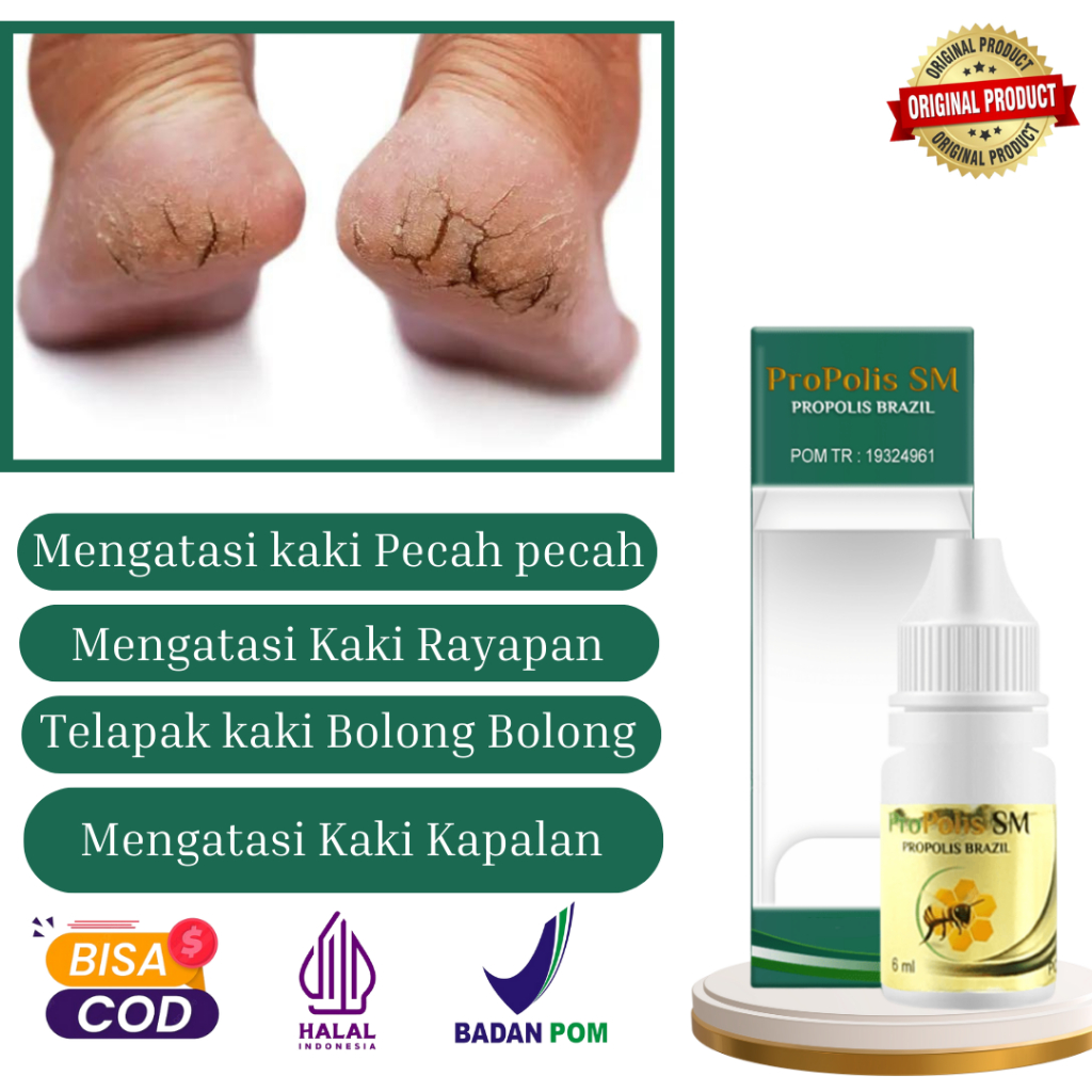 Jual Obat Kaki Rayapan Telapak kaki Bolong Bolong Rorombeheun Pecah ...