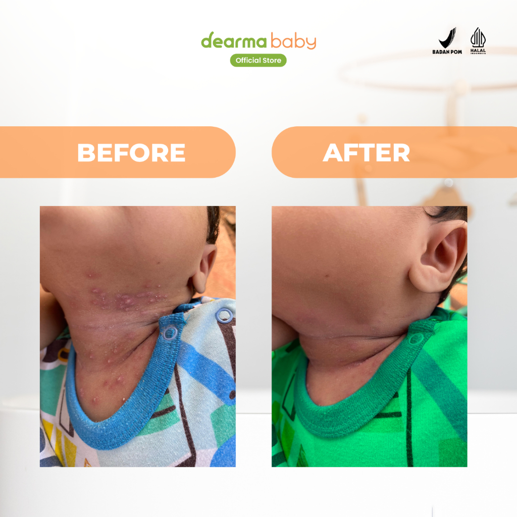 Jual Baby Rash Protection Cream (Redakan Ruam Popok, Ruam Susu, Biang ...