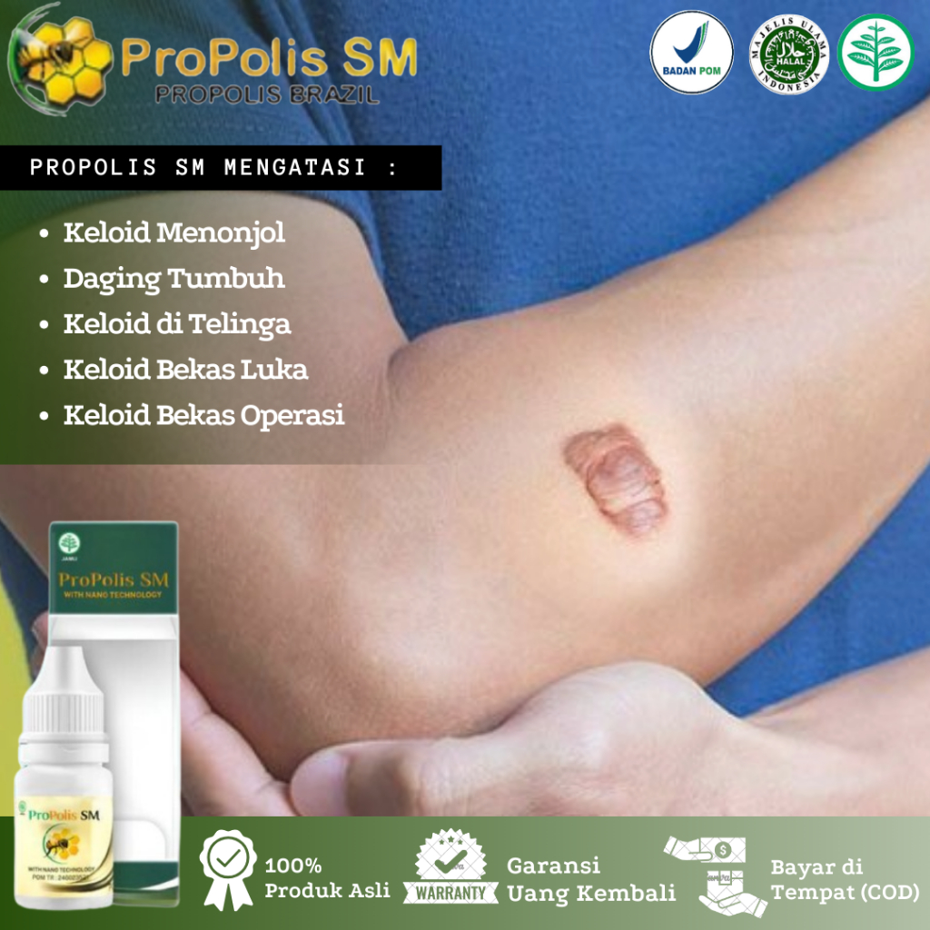 Jual Obat Keloid Menonjol, Daging Tumbuh, Keloid Bekas Luka, Keloid di Dada, Keloid Bekas ...