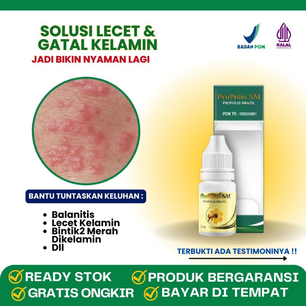 Jual Obat Lecet Kepala Kelamin Pria Balanitis Luka Bernanah Gatal ...