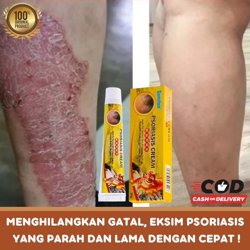 Jual Ampuh !!! Salep Obat Gatal Paling Ampuh Gatel Eksim Kering Menahun ...