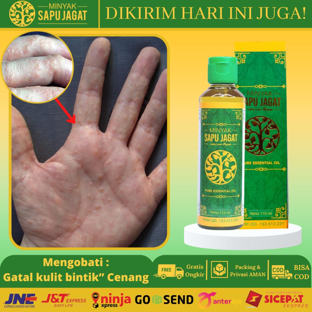 Jual Obat gatal kulit cenang bintik bintik, Obat tangan dan kaki bintik ...