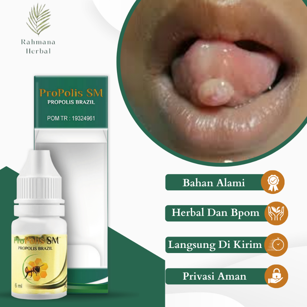 Jual Obat Benjolan Di Lidah, Obat Pngempis Benjolan Di Lidah, Obat ...