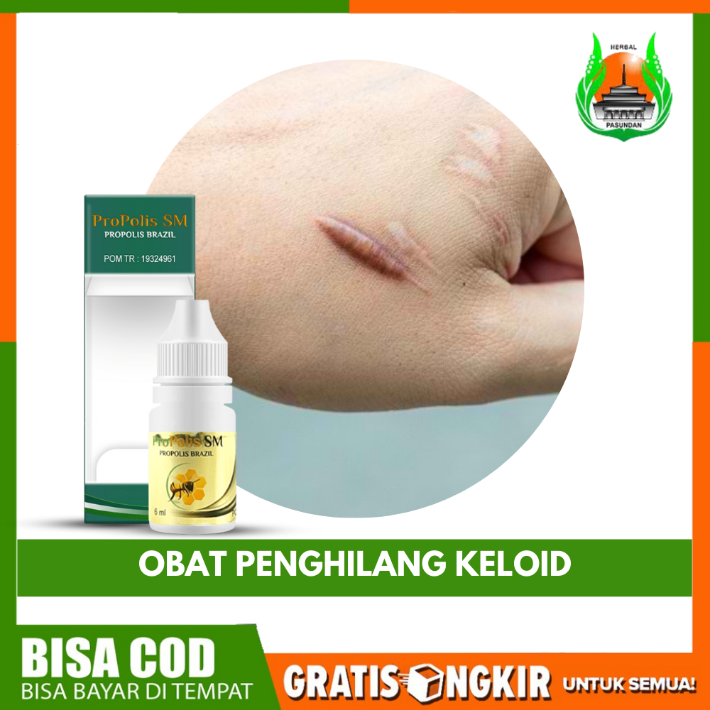 Jual Obat Keloid - Benjolan Di tangan Di Tubuh Benjolan Keras Bekas ...