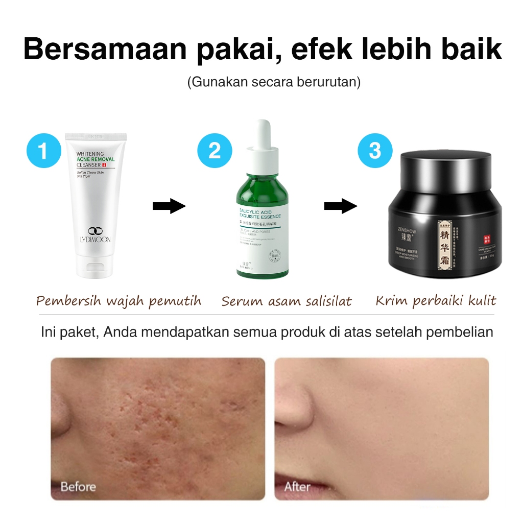 Jual Cream Penghilang Bekas Jerawat | Bopeng,dan Flek | penghilang ...