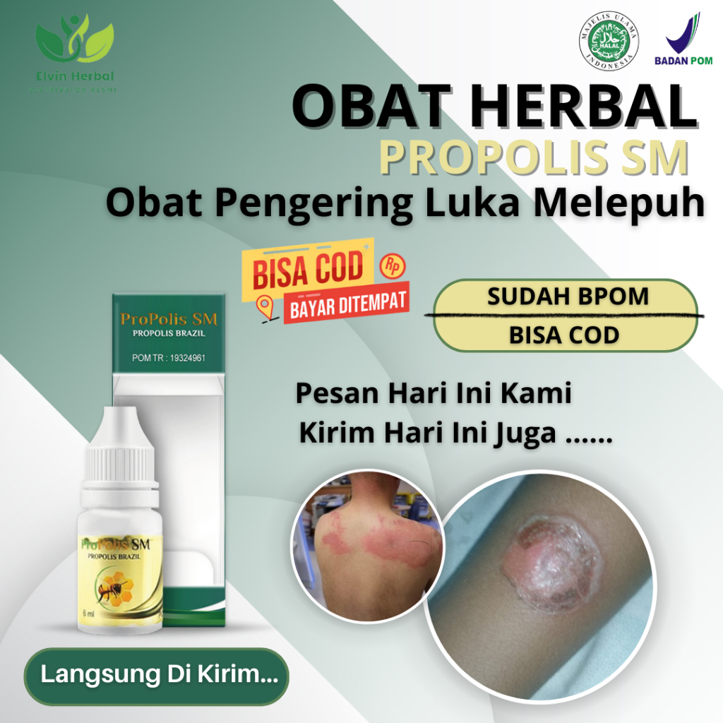 Jual Obat Untuk Luka Knalpot, Obat Luka Akibat Terkena Kenalpot, Luka ...