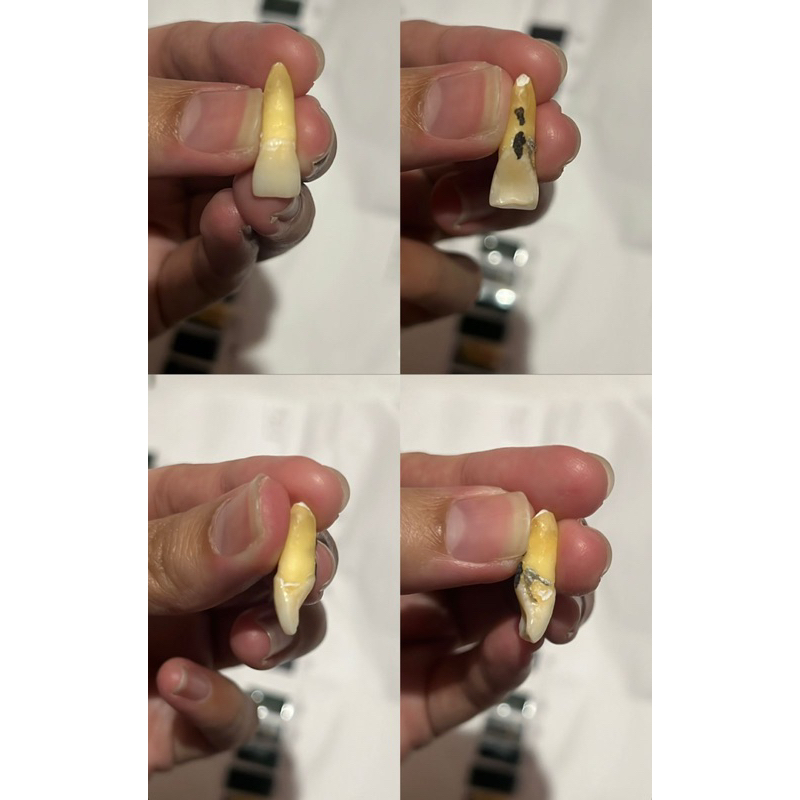 Jual Gigi insisivus 1 2 dewasa rahang atas kanan dan kiri (unsur 11 12 ...