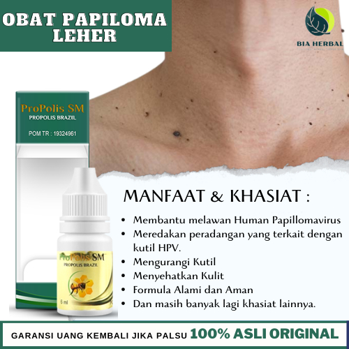 Jual Propolis SM - Obat Papiloma Leher - Penghilang Kutil Kulit ...