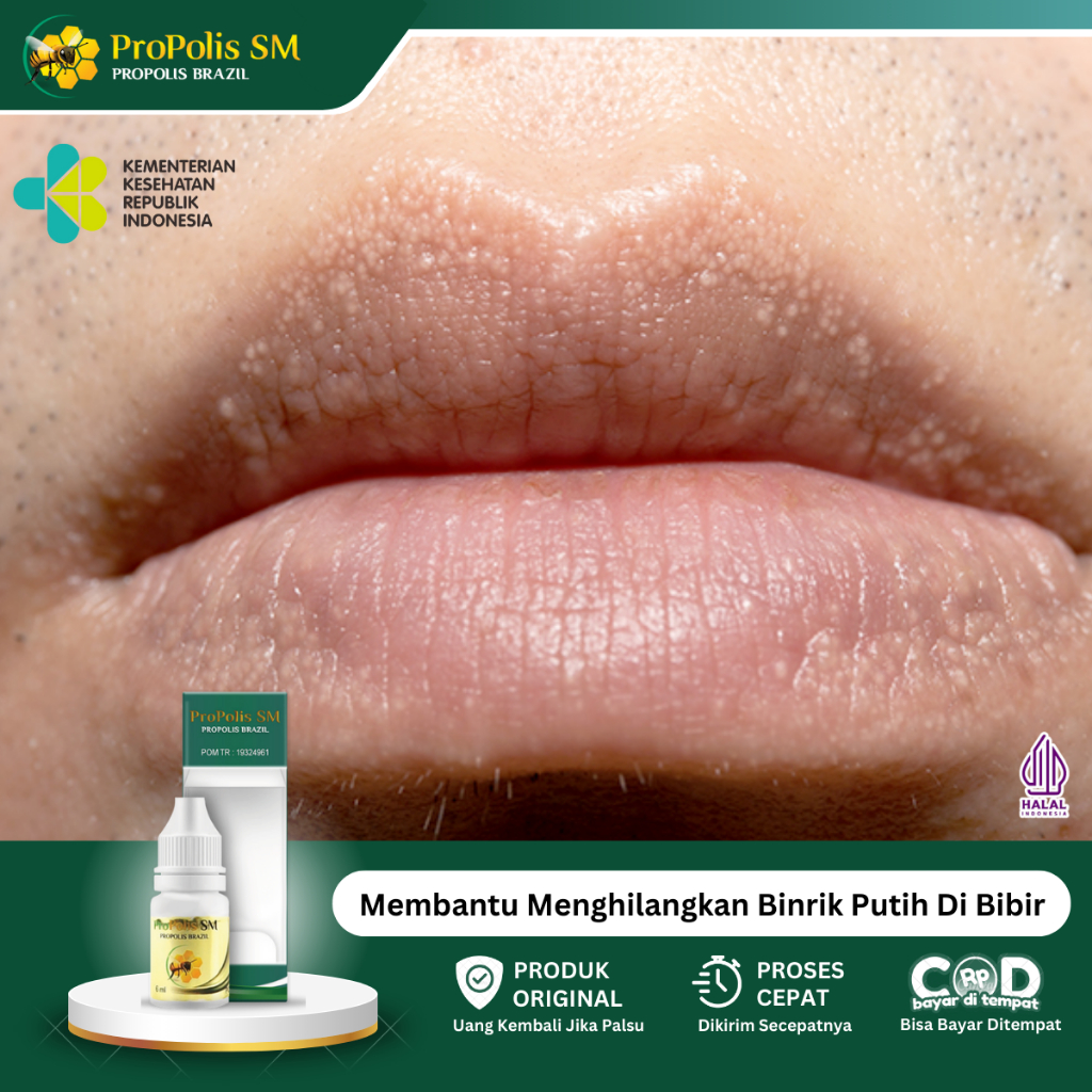 Jual Obat Penghilang Bintik Putih Di Bibir, Obat Fordyce Spot, Obat ...